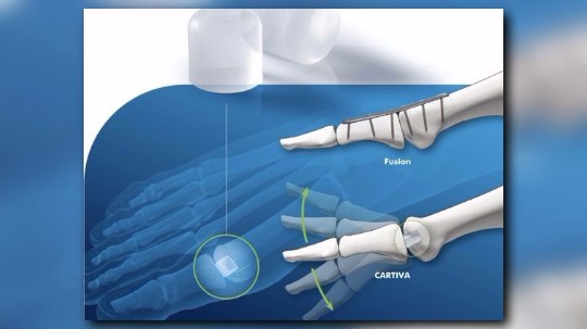 'Synthetic' cartilage is now an option for big-toe arthritis sufferers ...